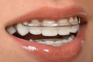 What is Malocclusion? Classes and Correction Options