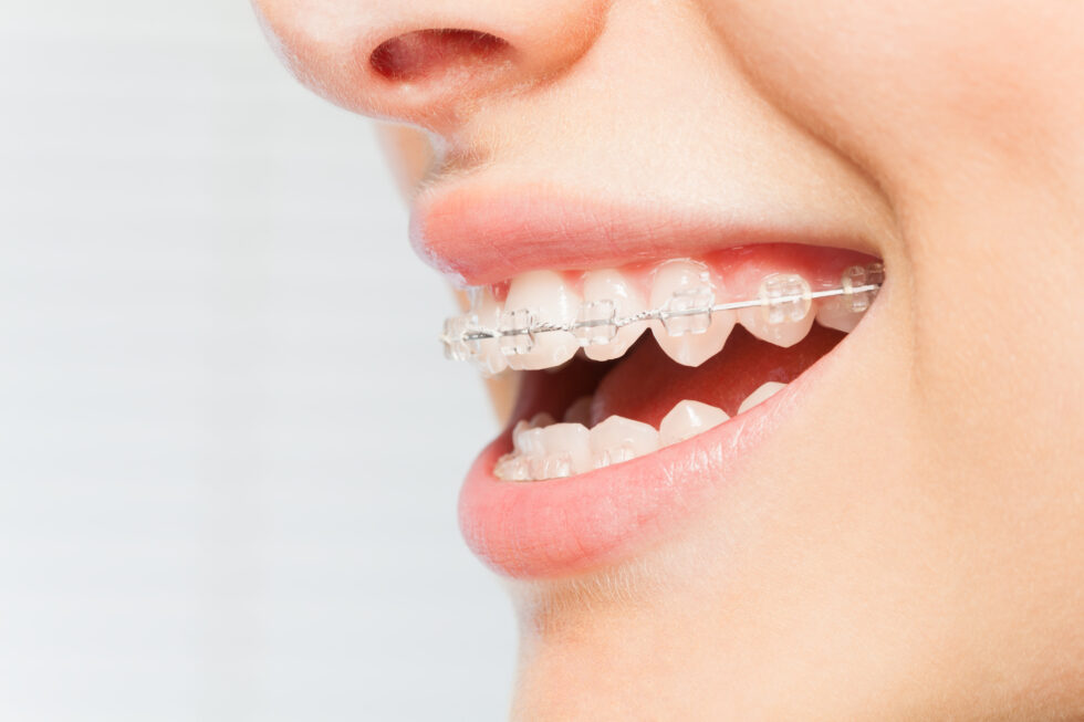 How Much are Braces? | Prices for All Brace Types in the UK