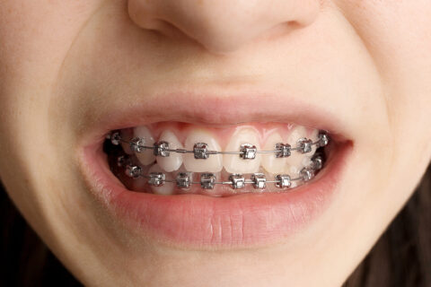 Your Guide to Getting Braces | Prepare With This Expert Advice