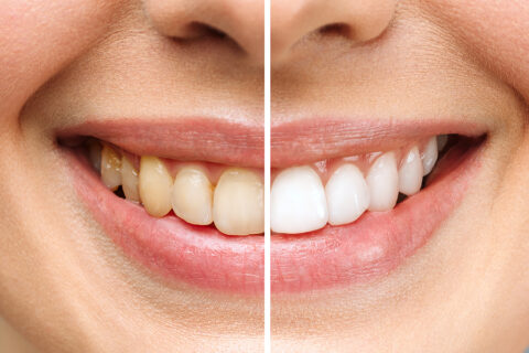 Stained Teeth | Common Causes and How to Get Rid of Stains