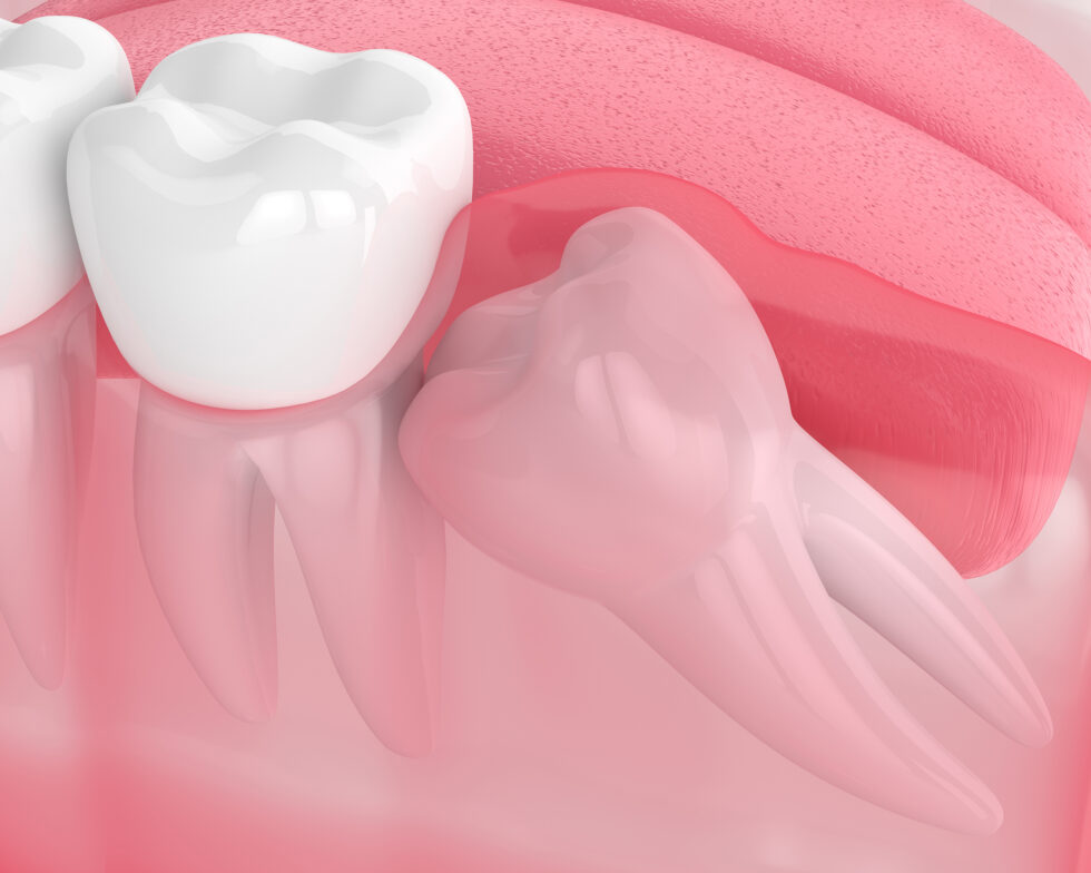 Impacted Tooth | Advice on Symptoms, Causes and Treatment