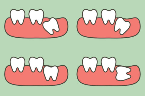 Impacted Tooth | Advice on Symptoms, Causes and Treatment